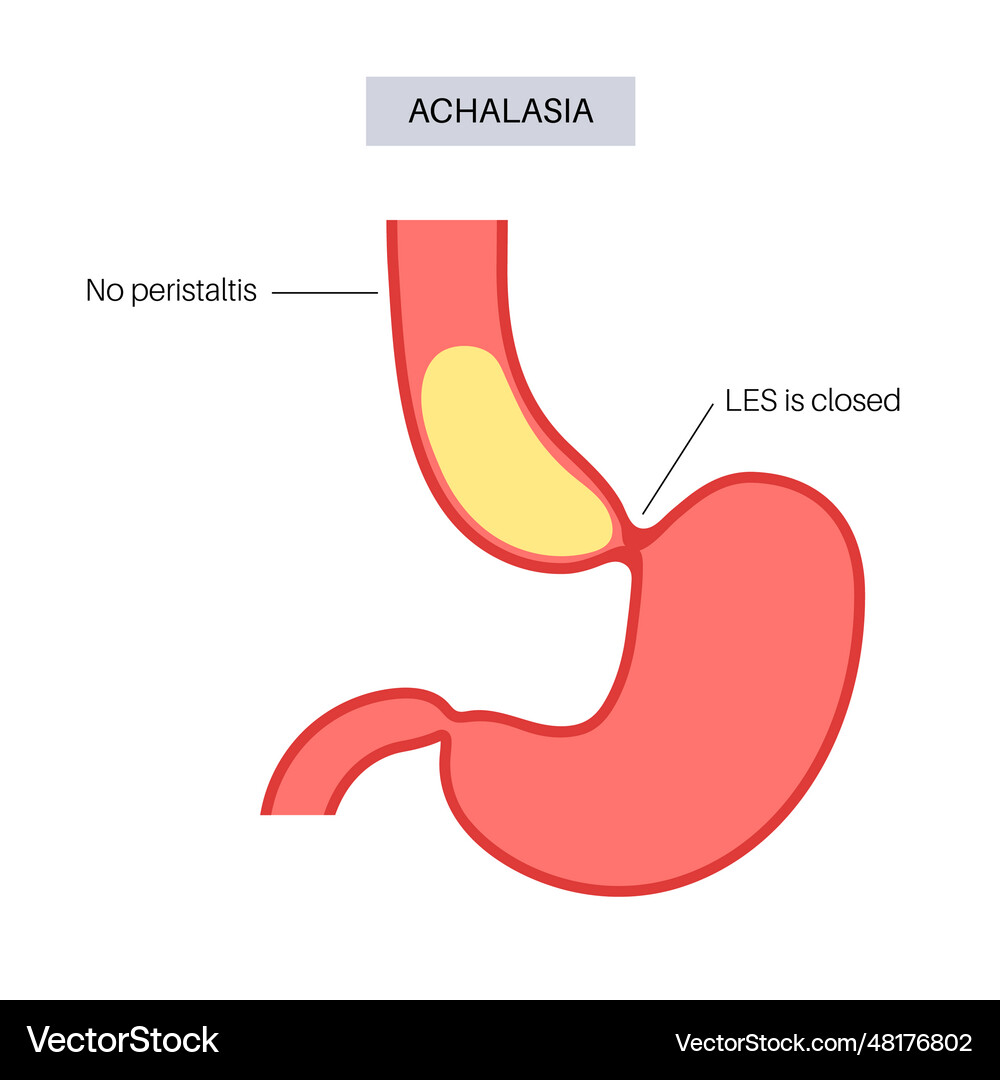 Esophageal achalasia disease Royalty Free Vector Image