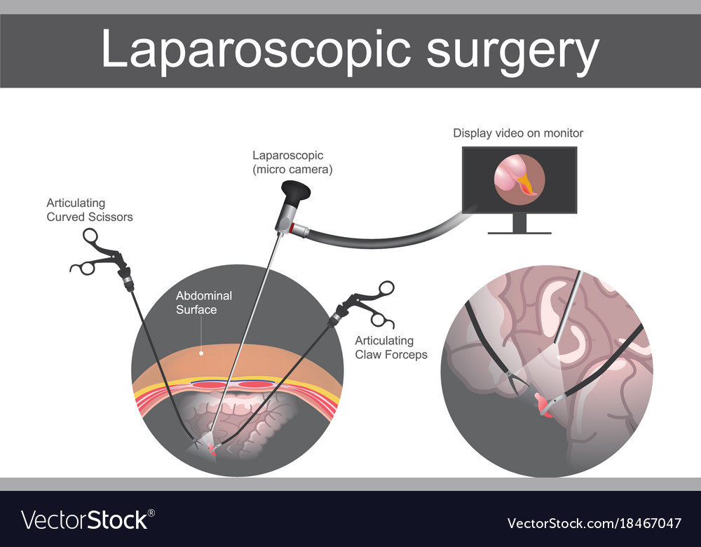Laparoscopic surgery technical which Royalty Free Vector