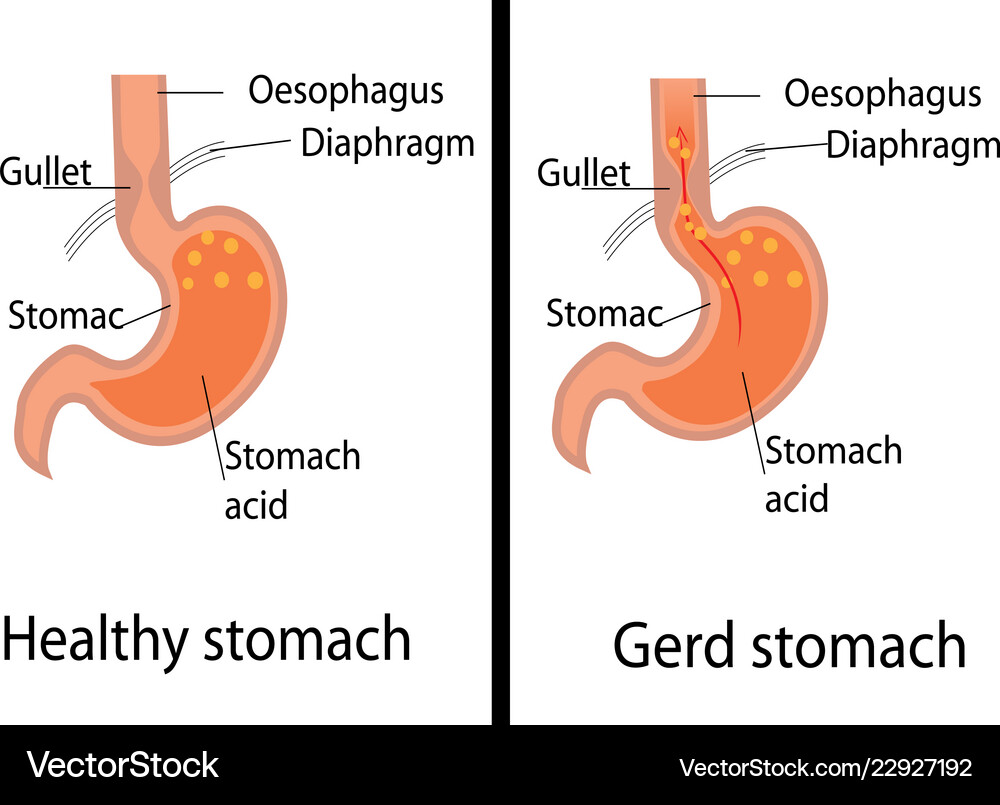Gastroesophageal acid reflux desease Royalty Free Vector