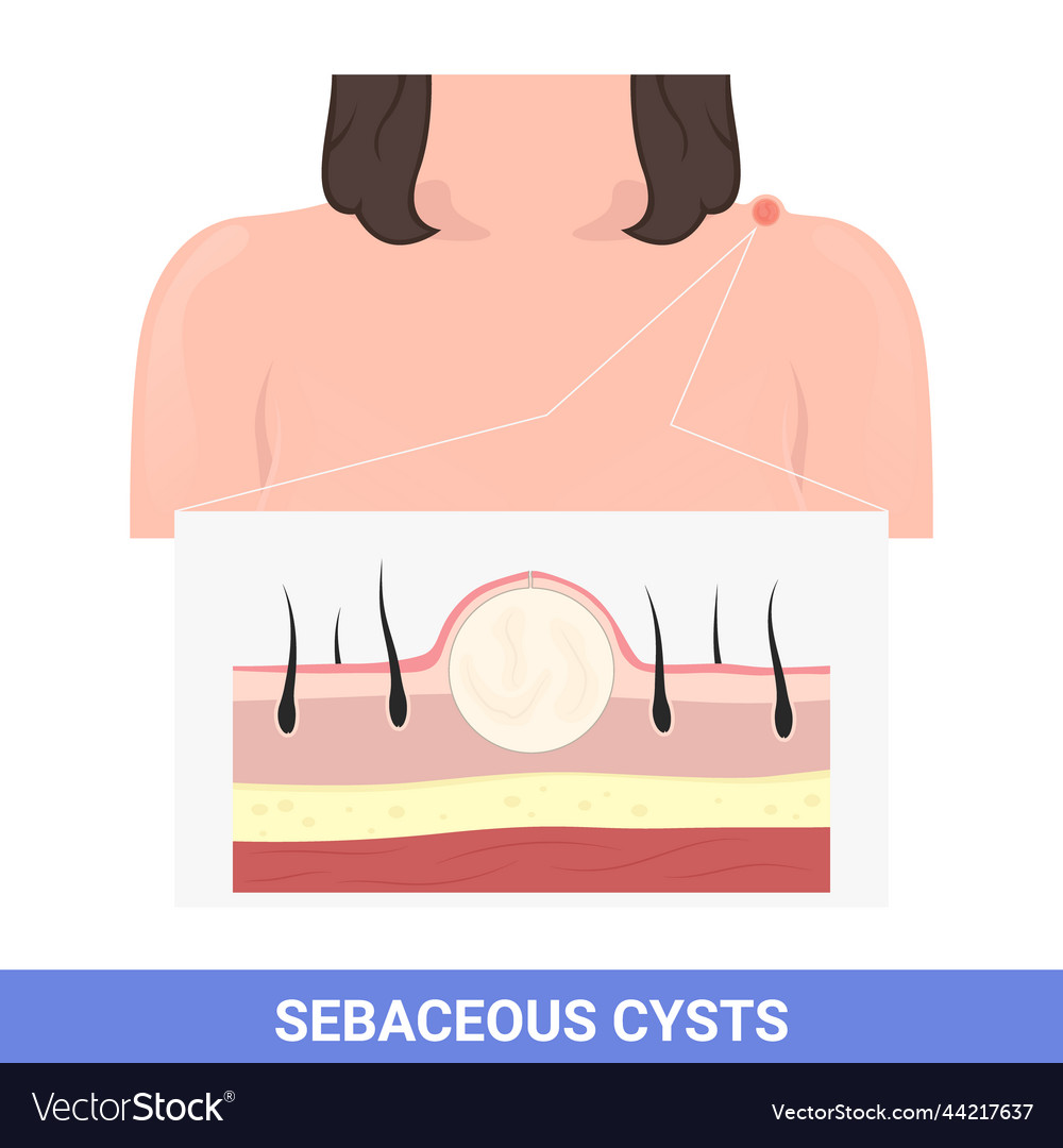 Cyst On Shoulder That Cause Swelling Royalty Free Vector