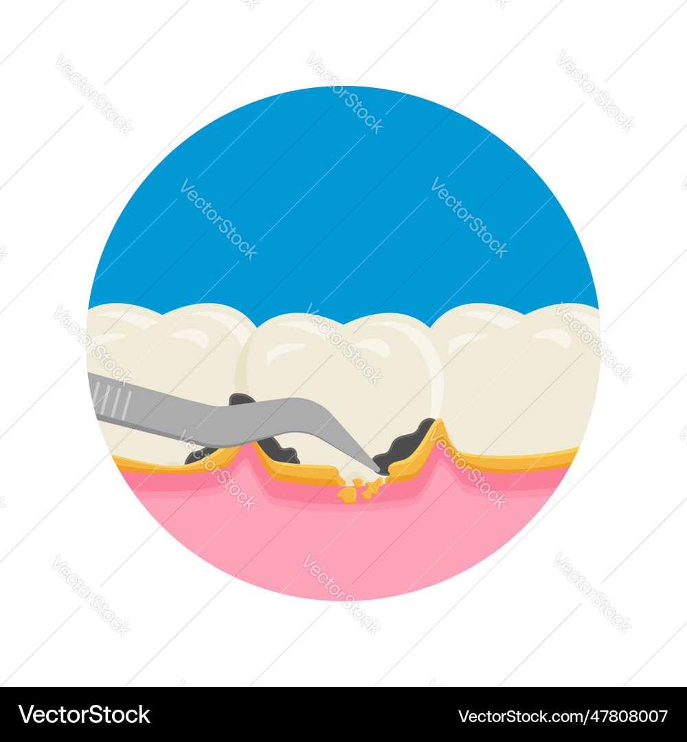 Teeth scaling dental plaque removal for cleaning Vector Image