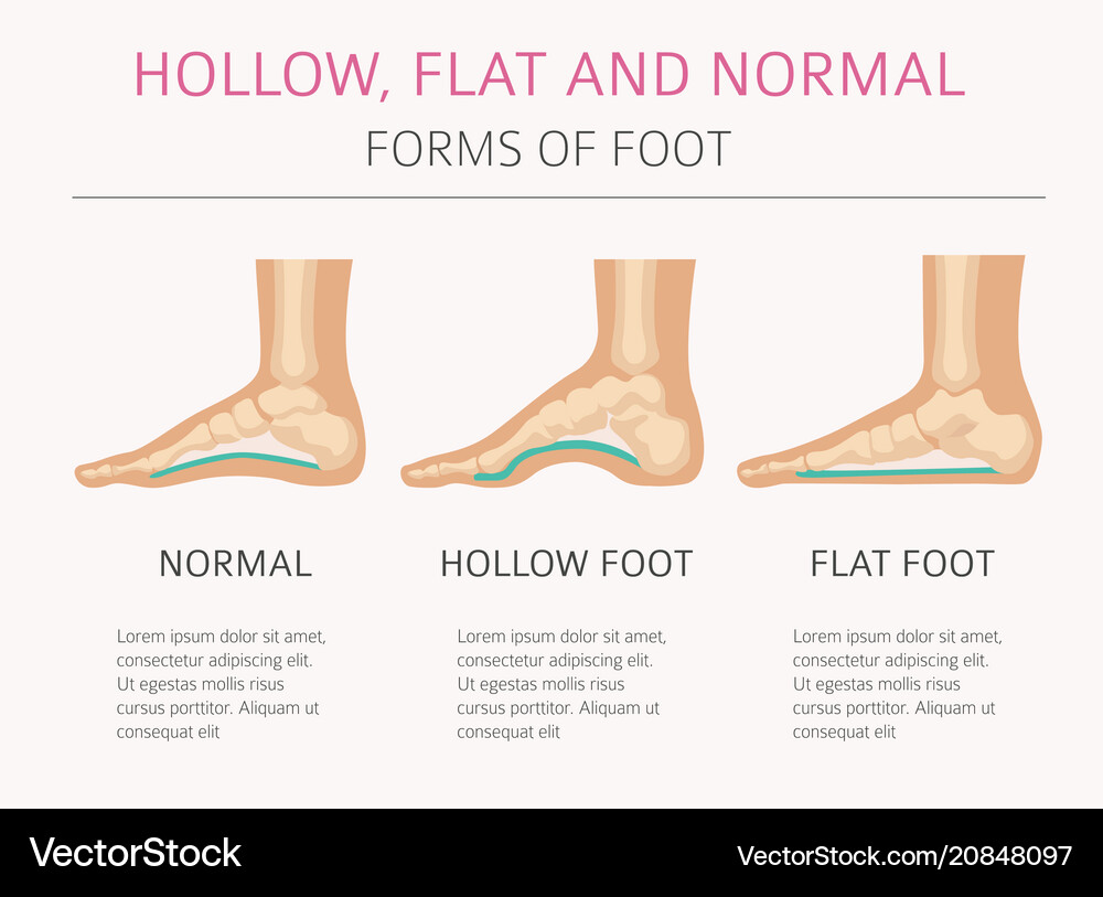 Foot deformation types medical desease Royalty Free Vector