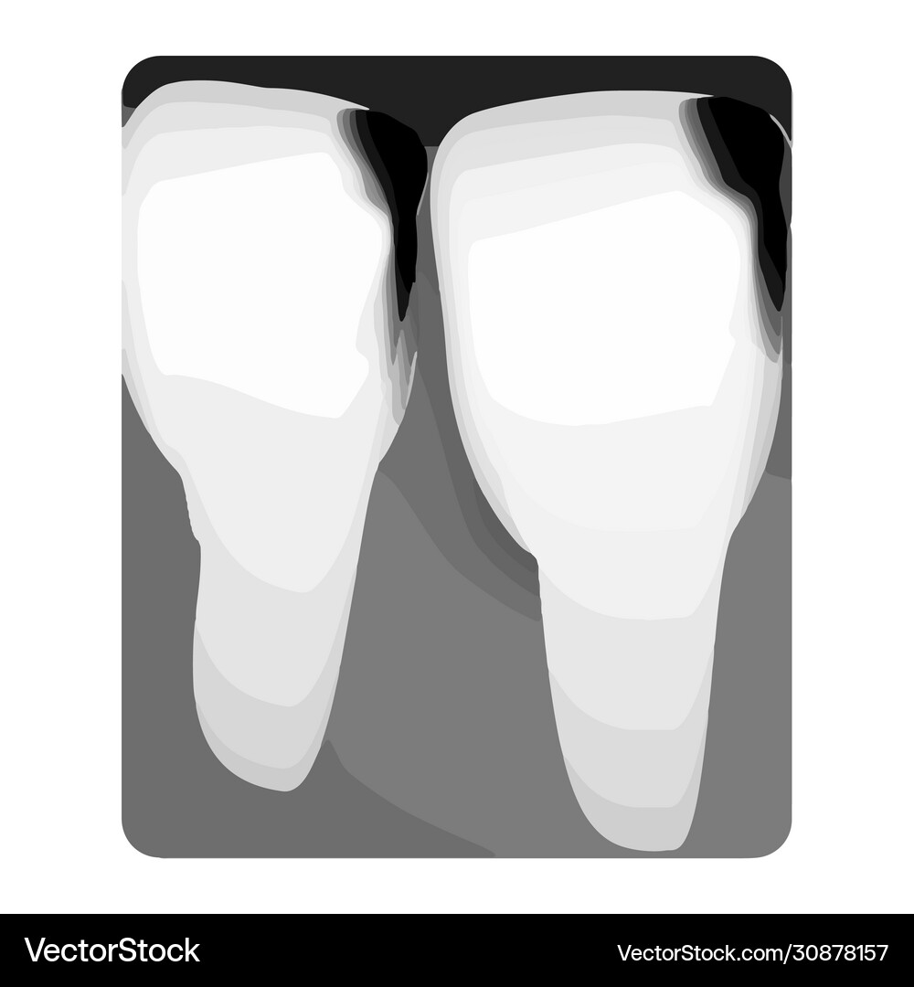 Dental caries x-ray tooth decay Royalty Free Vector Image