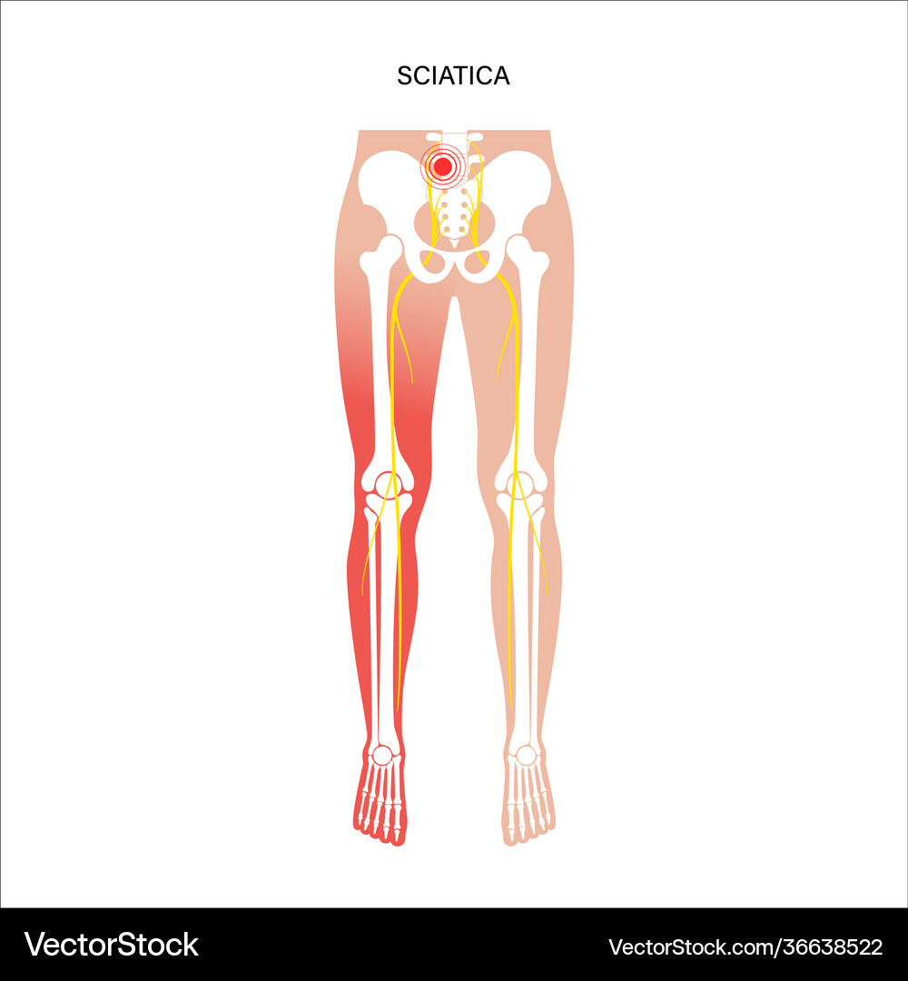 Sciatica Anatomy & Pain Royalty Free Vector Image
