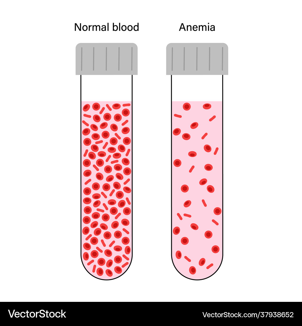 Blood Cell Anatomy & Anemia Royalty Free Vector Image