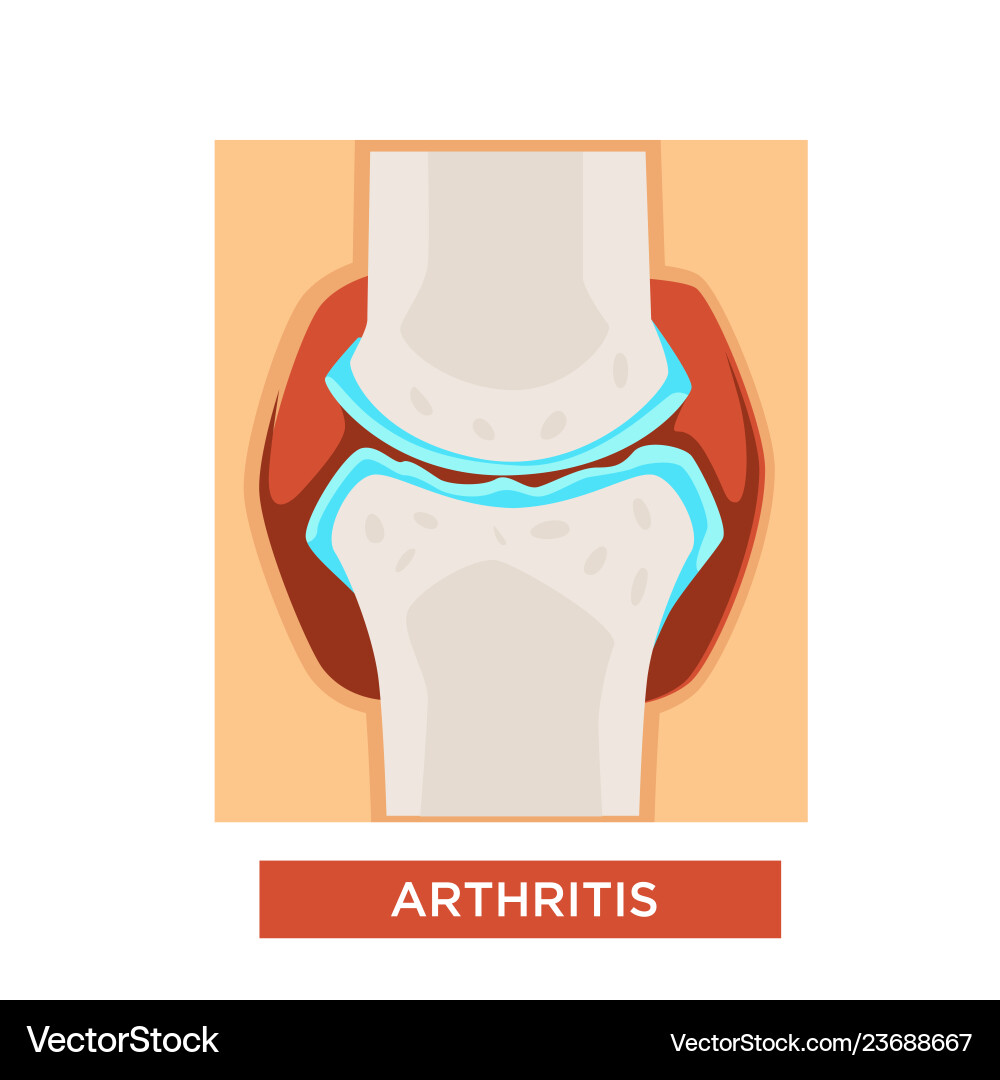 Arthritis bones or joint treatment rheumatology Vector Image
