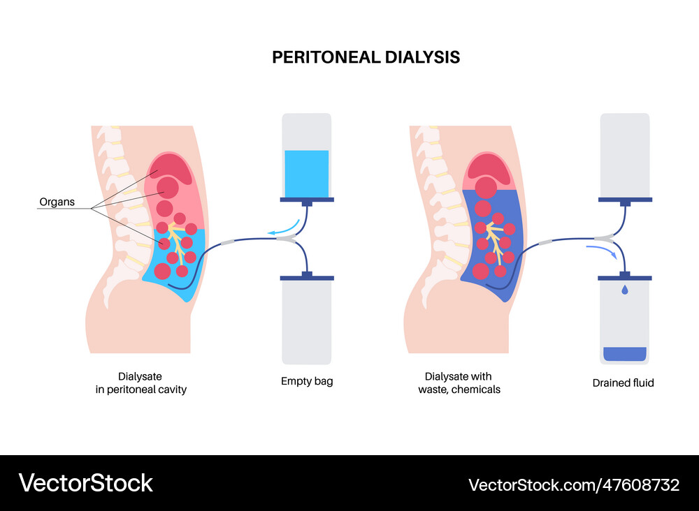 Peritoneal Dialysis Catheter Diagram