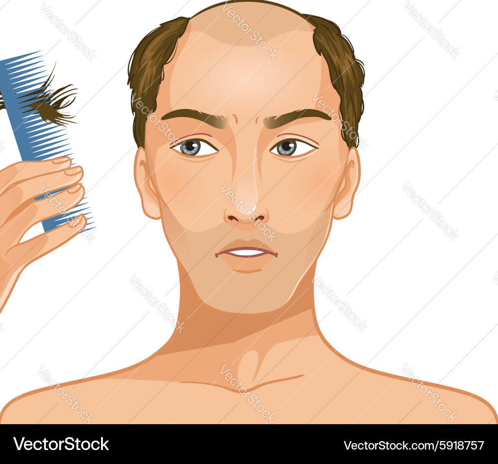 Young bald-headed man with hair fall eps10 Vector Image