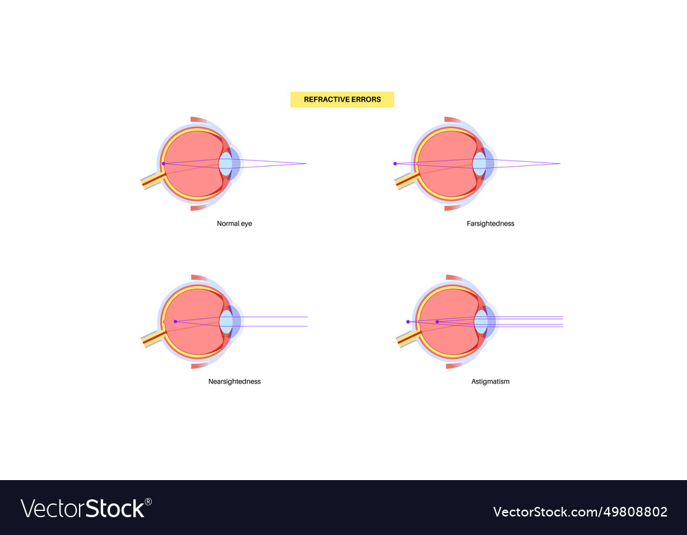 Refractive errors poster Royalty Free Vector Image Refractive errors poster Royalty Free Vector Image
