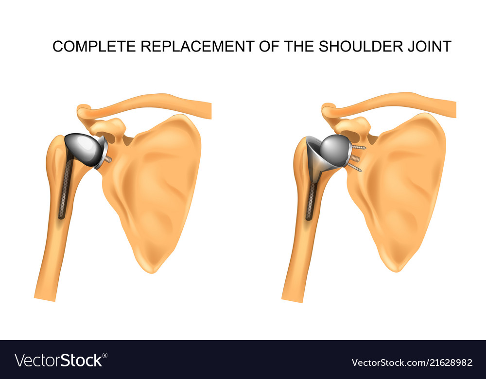 Types prosthesis shoulder Royalty Free Vector Image