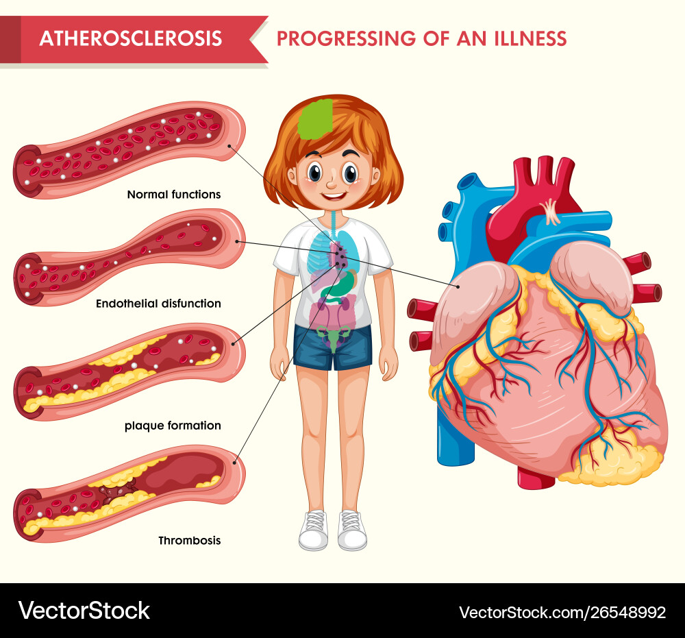 Scientific medical atherosclerosis Royalty Free Vector Image