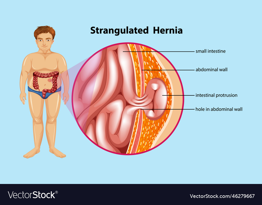 Diagram showing strangulated hernia anatomy Vector Image