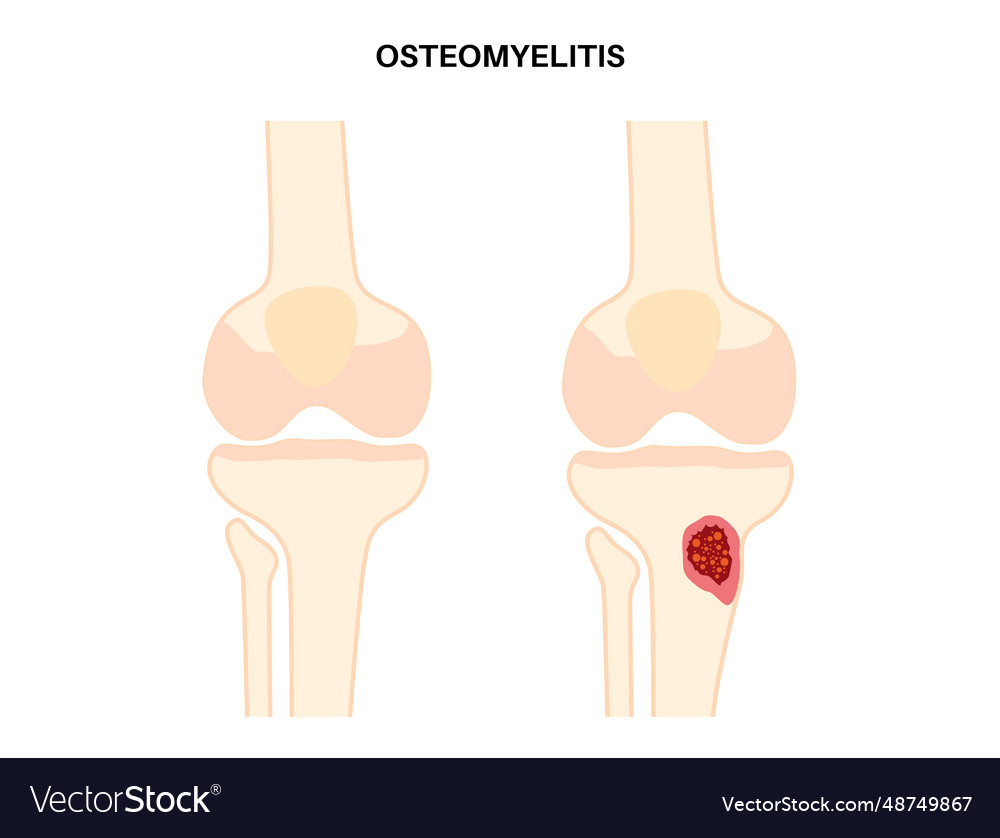 Tibia bone osteomyelitis Royalty Free Vector Image