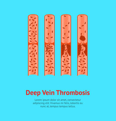Cartoon deep vein thrombosis infographics card Vector Image