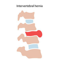 Hernia Vector Images (over 550)