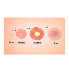 Stages development acne inflamed skin Royalty Free Vector