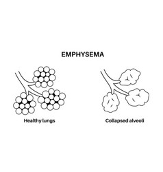 Emphysema anatomical poster Royalty Free Vector Image