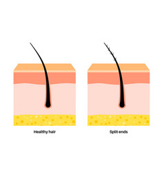 Pili multigemini hair disorder in close up Vector Image