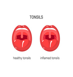 Tonsils and throat diseases tonsillitis symptoms Vector Image