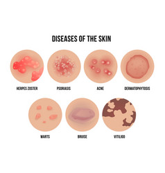 Skin disease types of dermatology problems with Vector Image