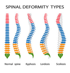 Spinal deformity types Royalty Free Vector Image