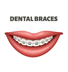 Dental braces background Royalty Free Vector Image