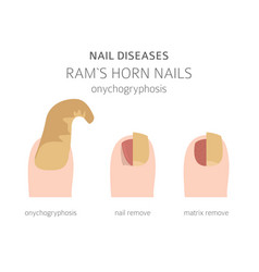 Nail diseases onychocryptocosis ingrown toenail Vector Image