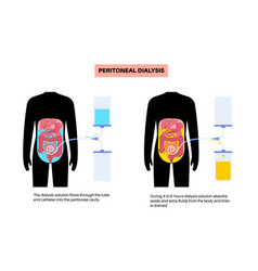 Peritoneal dialysis concept Royalty Free Vector Image