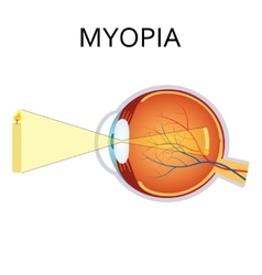 Myopia Royalty Free Vector Image - VectorStock