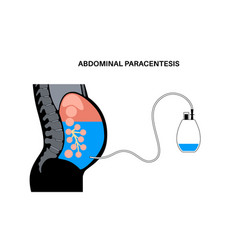Abdominal paracentesis poster Royalty Free Vector Image